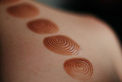 Cupping Marks Explained: Unraveling the Mystery - Wellness Wise Hub